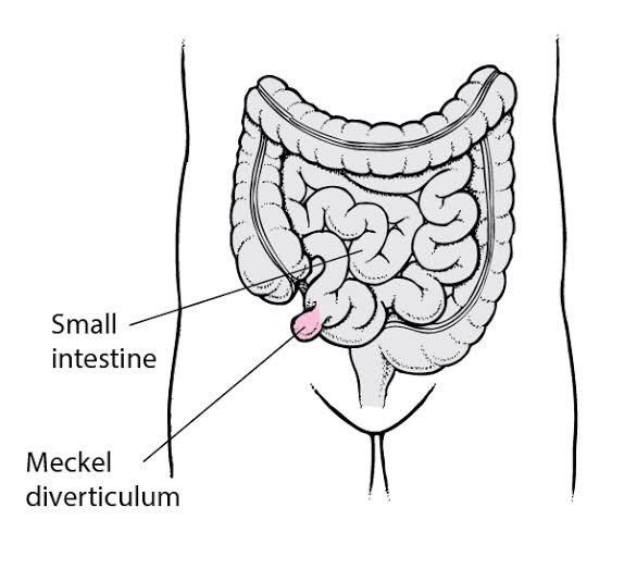 Understanding Meckel’s Diverticulum Resection: A Surgeon’s Perspective ...