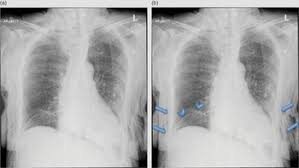 Epicardial Fat Pad: What Your Chest X-Ray Reveals - Activegaliano.org