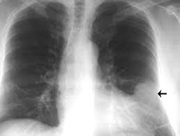 Epicardial Fat Pad: What Your Chest X-Ray Reveals - Activegaliano.org