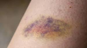 BE CAREFUL, if you get these bruises on your body, here’s what it means....