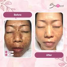 Shakura Pigmentation Beauty - Junction 8 | Melasma, Freckles, Age Spots ...