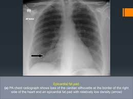 Epicardial Fat Pad: What Your Chest X-Ray Reveals - Activegaliano.org